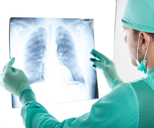 Cancerul pulmonar poate să rămână în stare latentă chiar şi 20 de ani