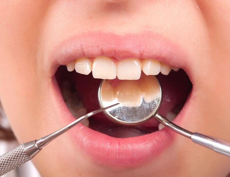 10 mituri despre plombe dentare şi carii