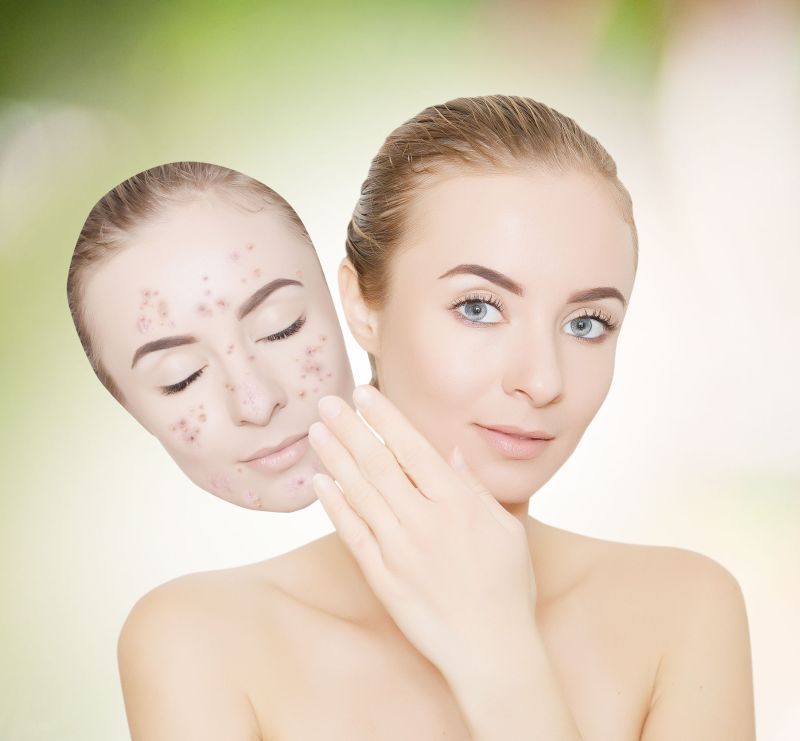 Motivele pentru care acneea se agravează primăvara