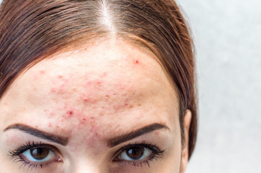 Coşuri pe frunte: cauze şi remedii naturale