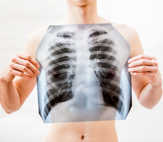 Despre fumat, cancer de plămâni şi metode de tratament cu un specialist ...