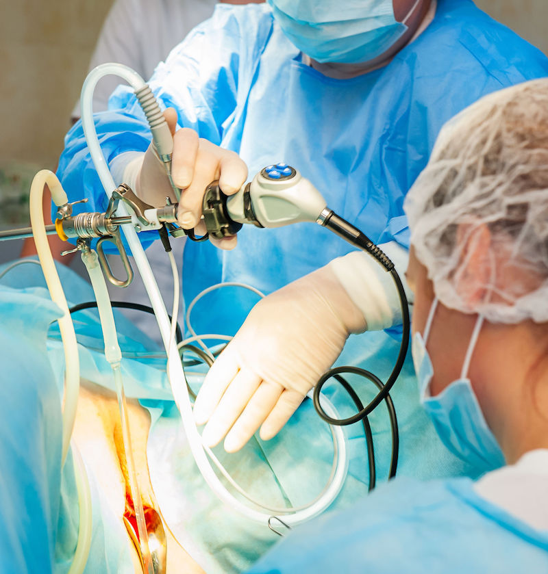 Refluxul gastroesofagian: tratamentul chirurgical