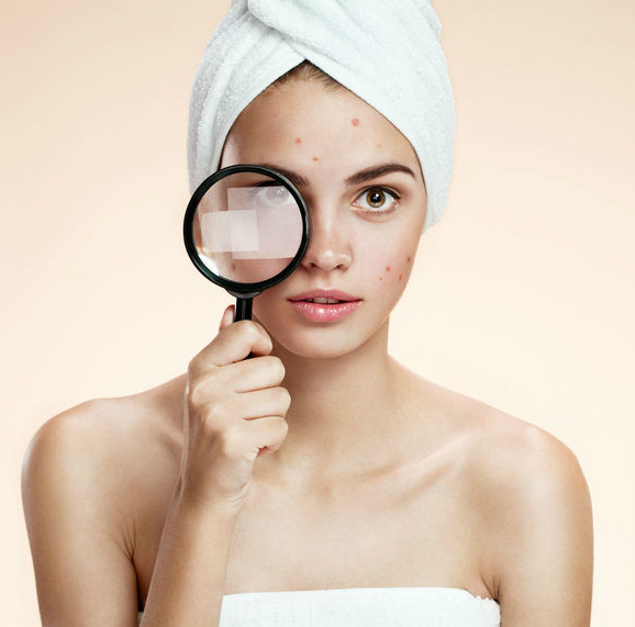 Acneea şi legătura cu alimentaţia: mit sau realitate?