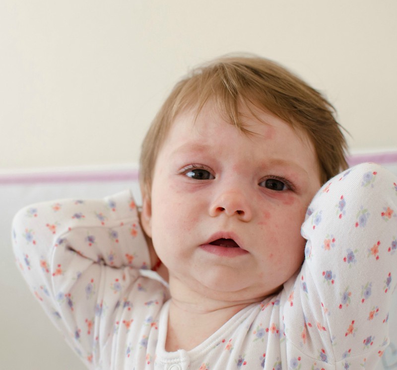 Rubeola: simptome, tratament