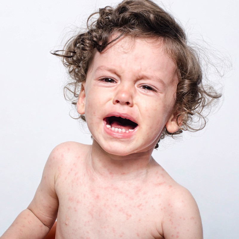 Rujeola: simptome, tratament