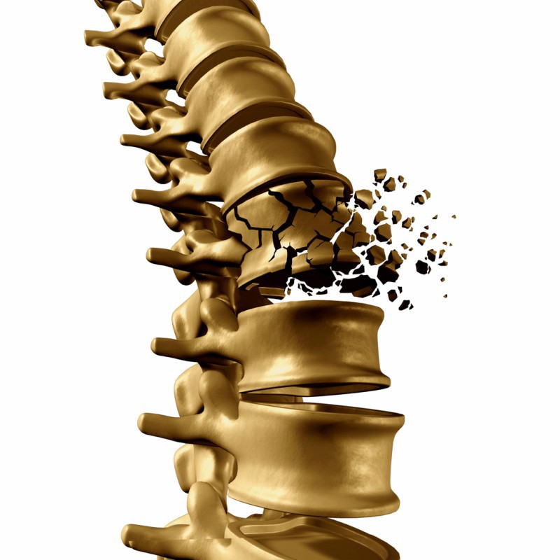Osteonecroza (infarctul osos): cauze, simptome, tratament
