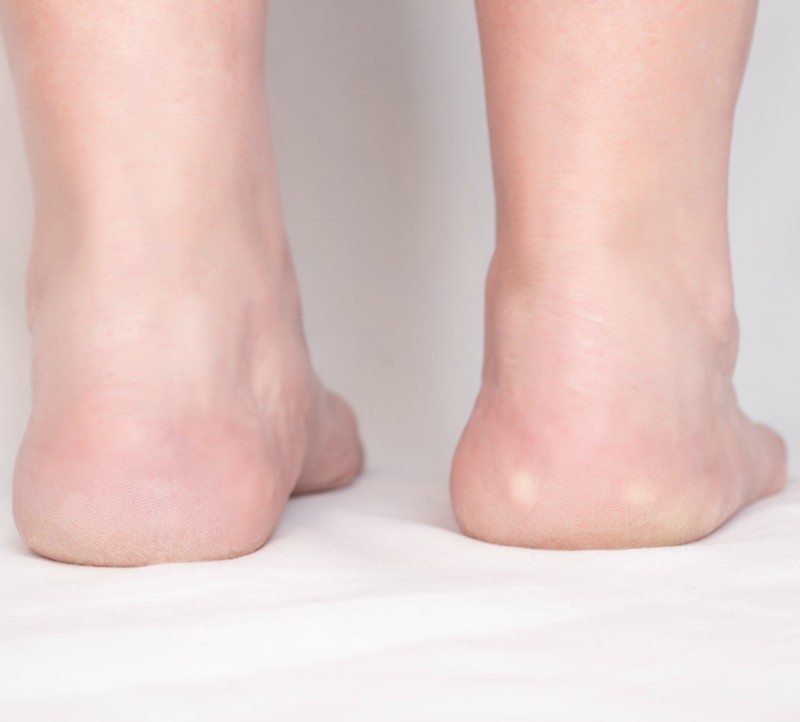 Osteofitoza: cauze, simptome, tratament