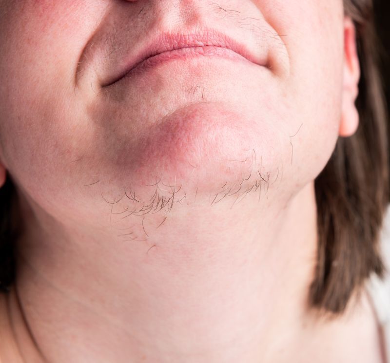 Virilismul (virilizarea): ce este, cauze, simptome, tratament