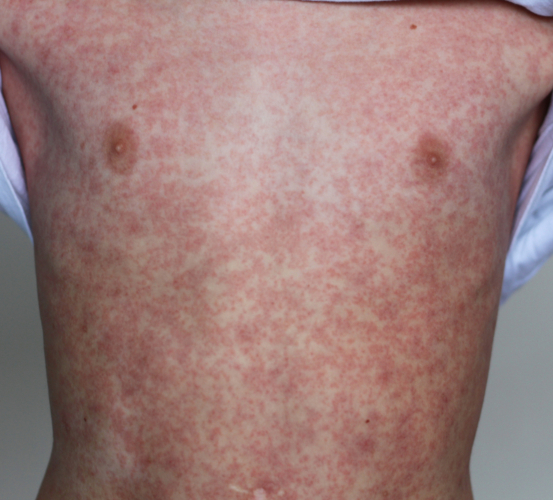 19.259 de cazuri de rujeolă (pojar) în România. Iată câte decese s-au ...