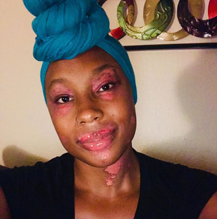 Sindromul Stevens-Johnson, o boală rară de piele