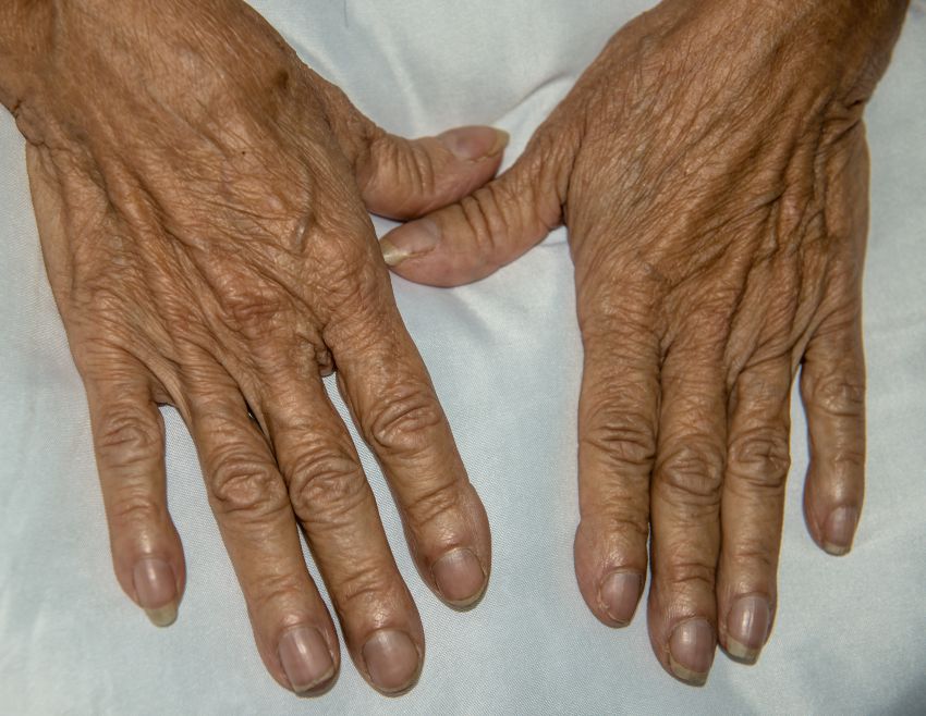 Aspectul degetelor și al feței poate da de gol cancerul pulmonar