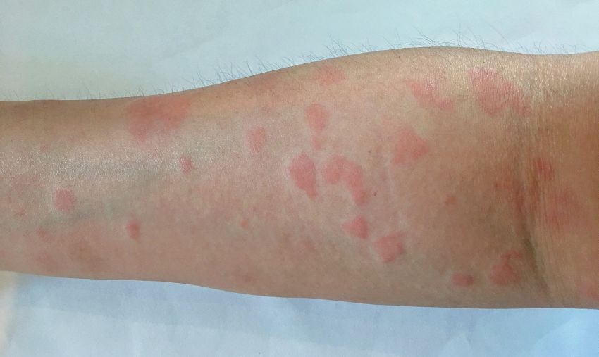 Simptomele lupusului, boala cu o mie de fețe frecvent diagnosticată greșit