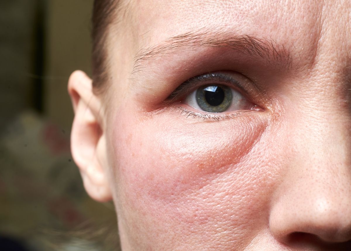 Te trezești cu fața umflată? Ce alimente și boli pot duce la umflarea feței