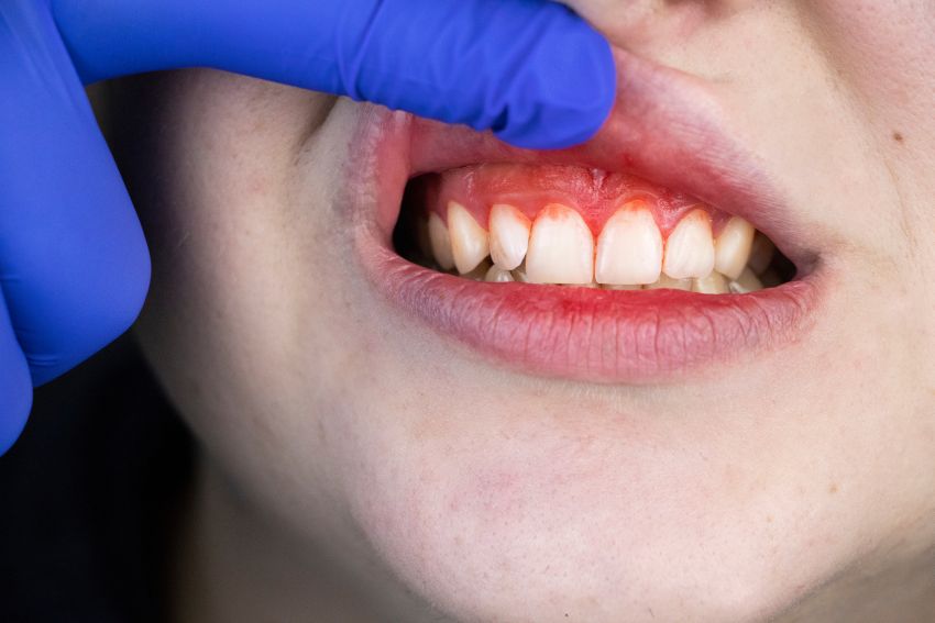 Gingii inflamate, sângerări? Iată ce trebuie să știi despre gingivită