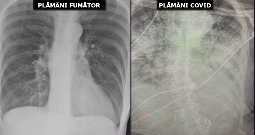 Plămâni de fumător versus plămâni COVID: cum arată radiografia ...