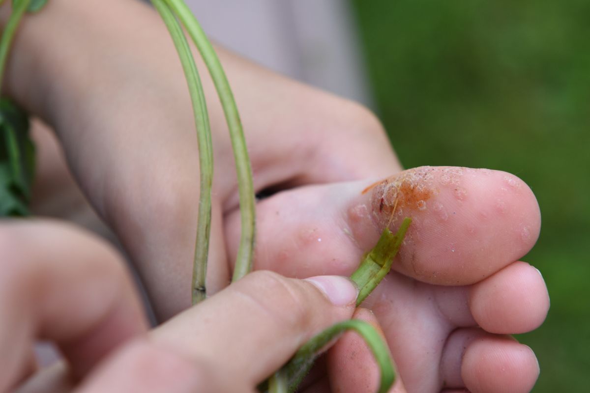 Tratament negi cu bicarbonat și rostopască. Remedii pentru negi