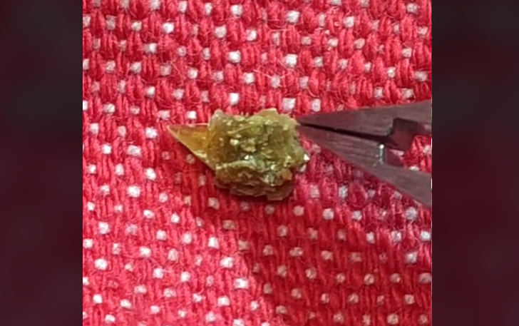 Piatra la rinichi „înfricoșătoare”, eliminată natural de un bărbat ...