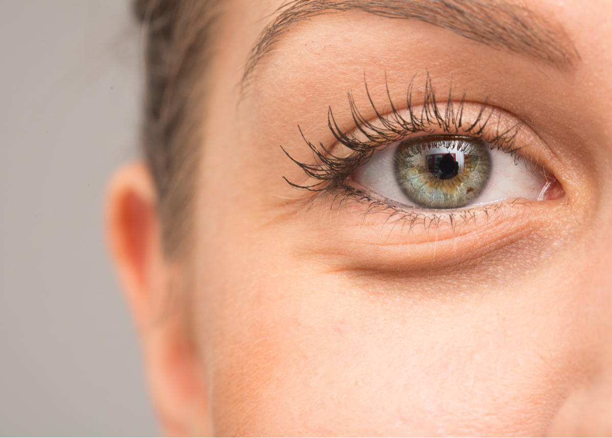 Cearcănele adânci: cauze și tratament