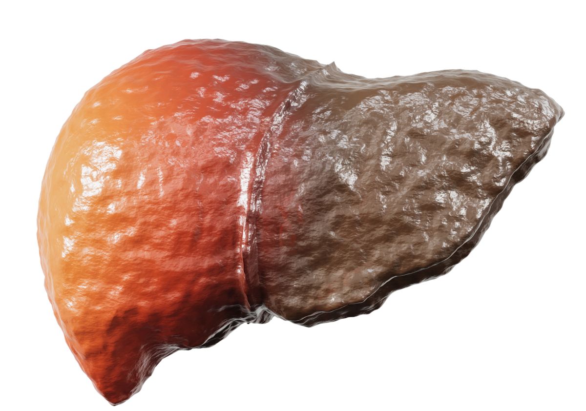 Medic gastroenterolog: Cei mai mulți dintre pacienții cu ficat gras ...