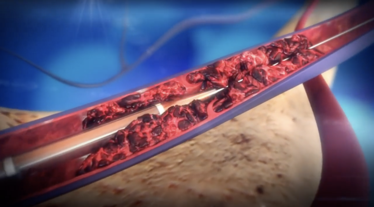 Tromboza venoasă profundă: cauze, diagnostic, tratament