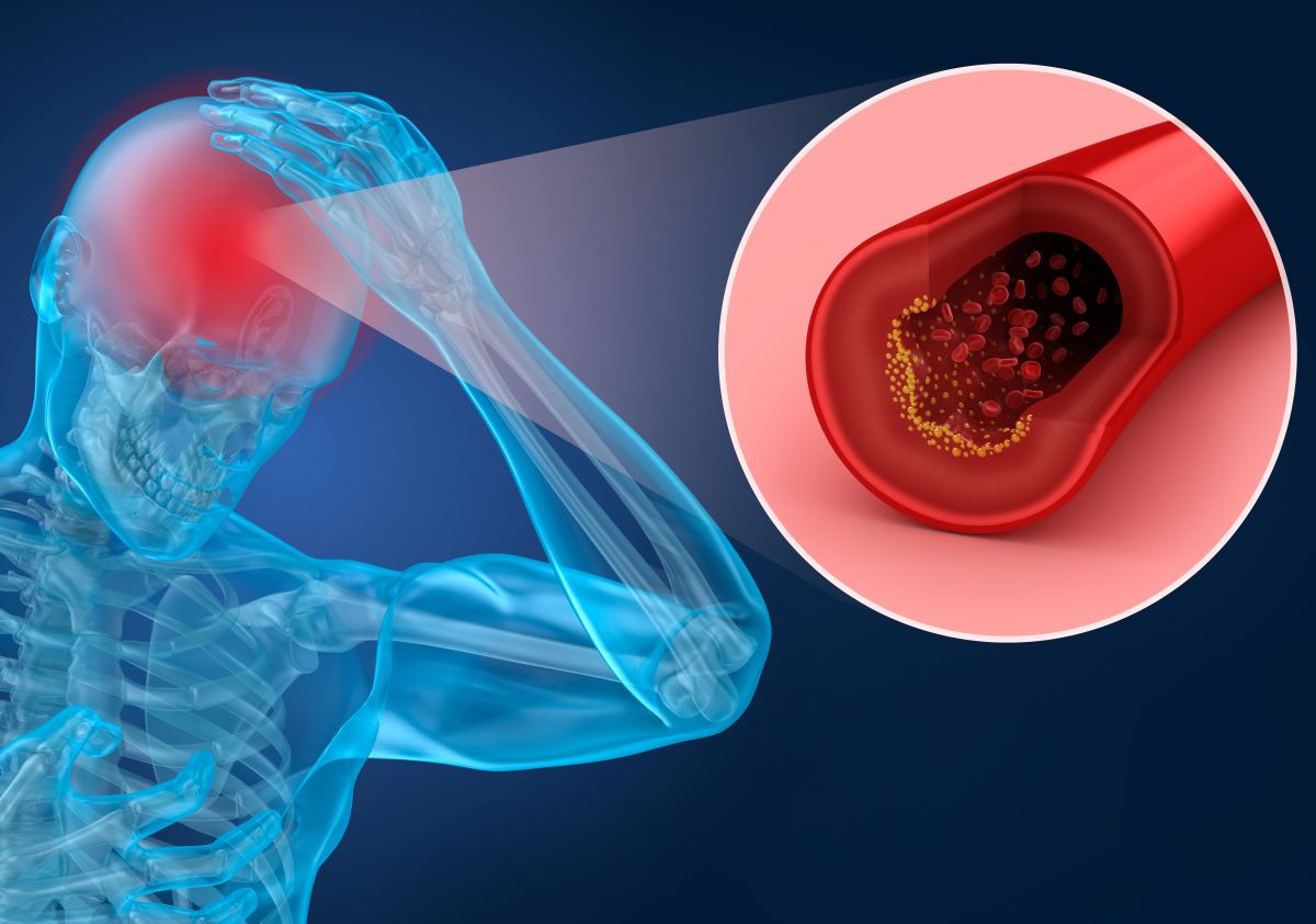 Cel mai eficient tratament pentru accidentul vascular cerebral