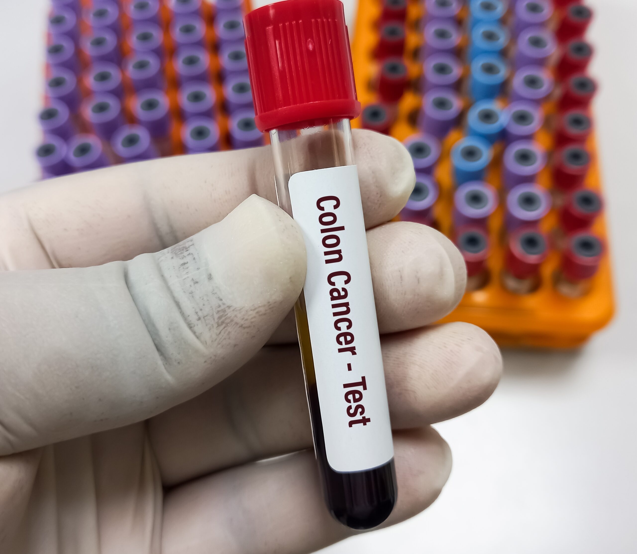 Testul de sânge gratuit care ajută la descoperirea cancerului de colon ...