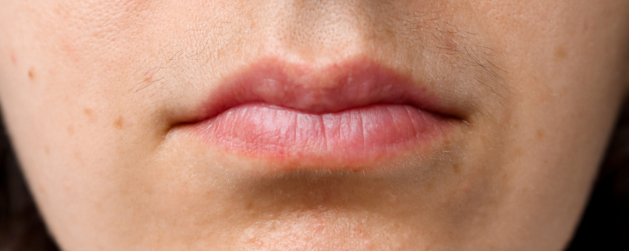 Hirsutism: cauze, simptome, tratrament