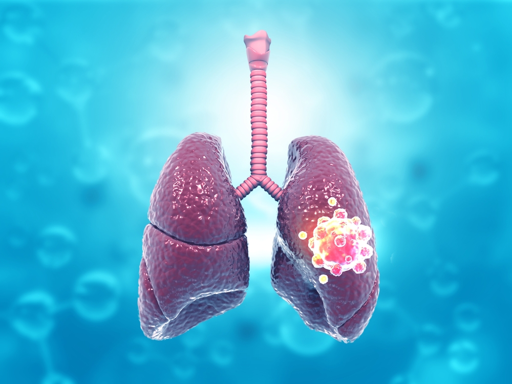 Care sunt cele mai indicate tratamente pentru cancerul pulmonar?