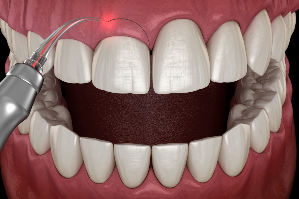 Tratamentul ortodontic al zâmbetului gingival. Ce facem când se vede ...