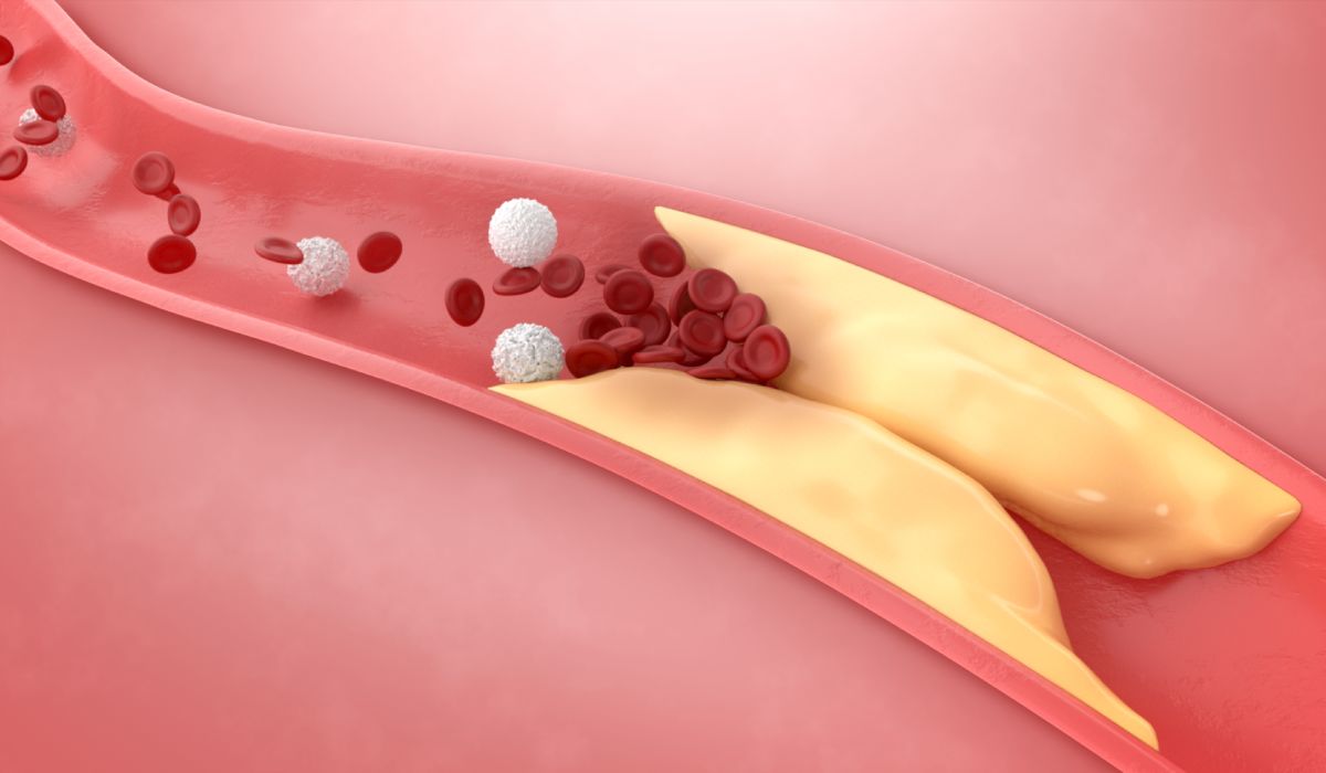 Colesterolul crescut la bărbați. Semnele ușor de identificat