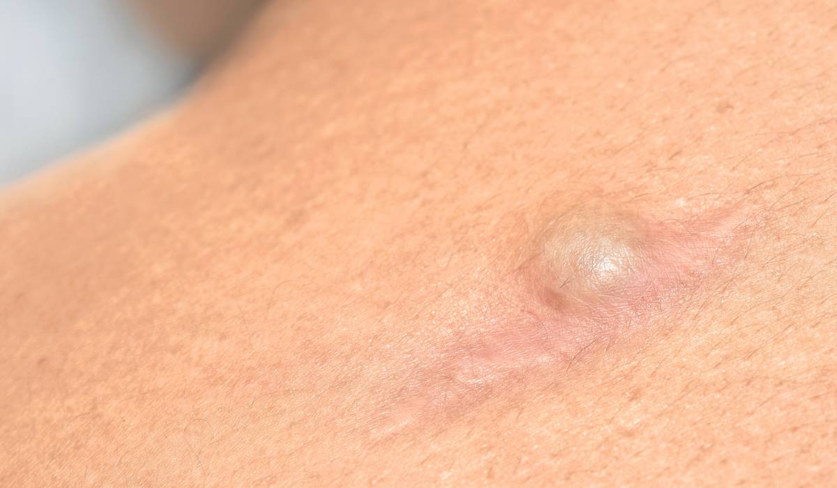 Greșeala pe care o faci și care duce la reapariția chistului sebaceu