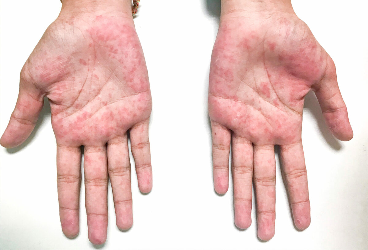Eczema dishidrotică: ce este, simptome și tratament