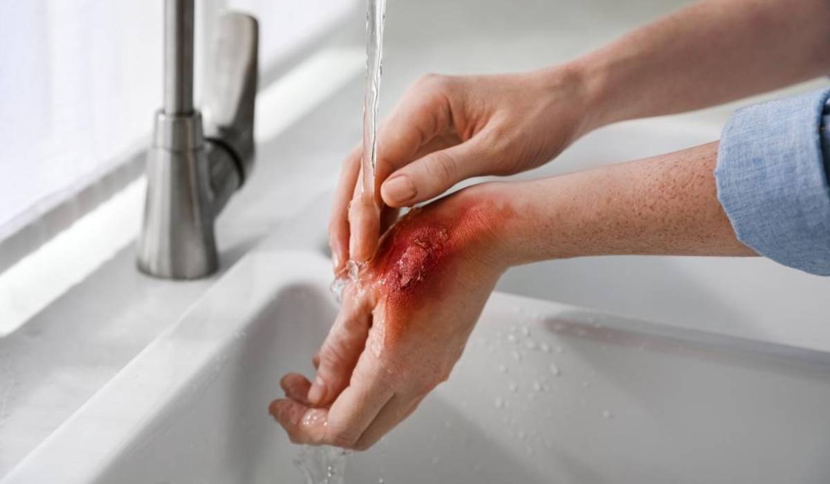 (P) Cea mai bună cremă pentru arsuri și cicatrici: ce trebuie să ...