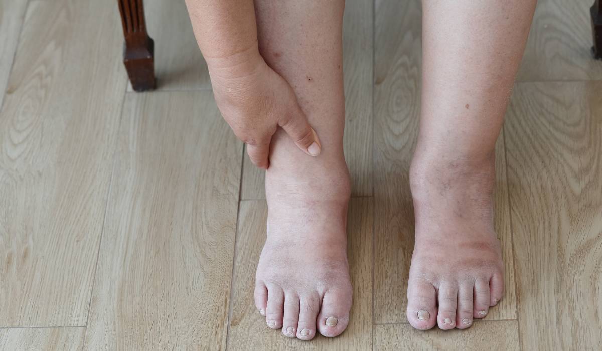 Ai mâini și picioare umflate vara? Boala care stă în spatele acestui ...