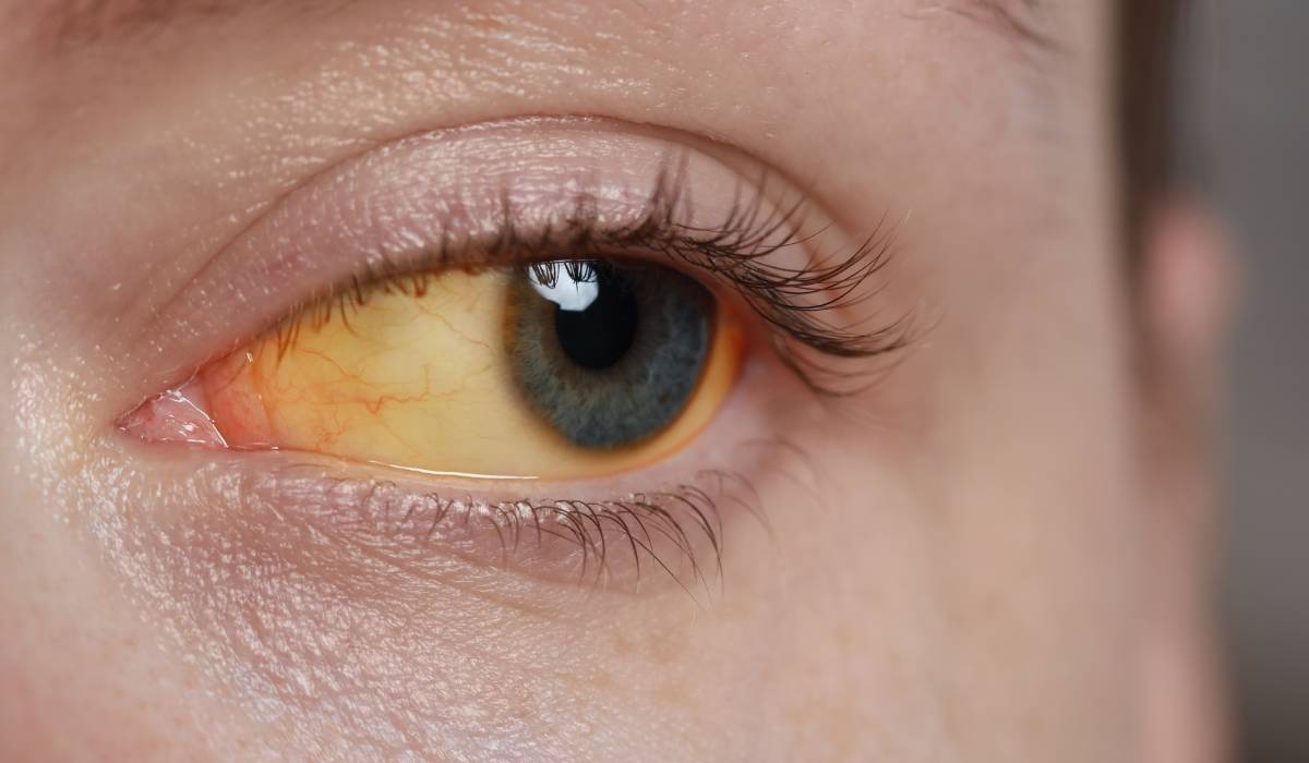 Ce îți spune „mucusul ocular” despre sănătatea ochilor: culorile care ...